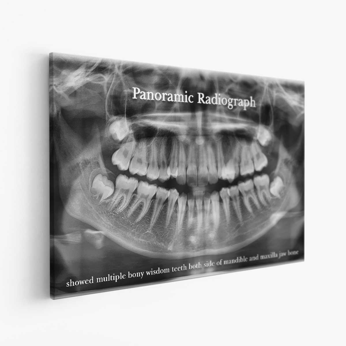 Panoramic radiograph showed multiple bony wisdom teeth both side of ma ...