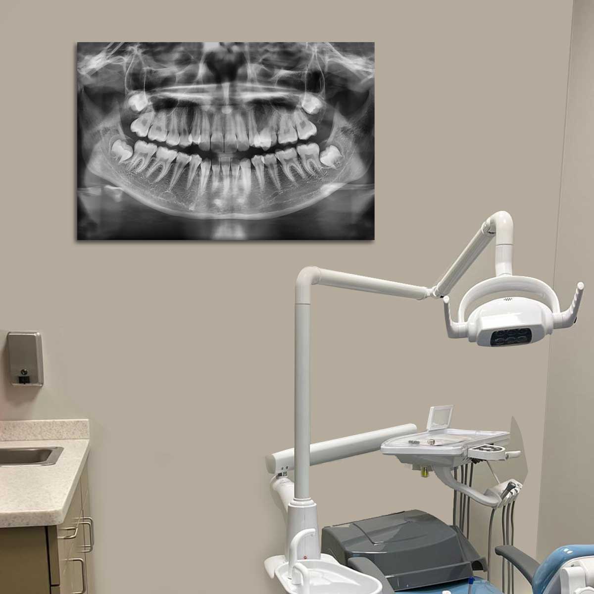 Panoramic radiograph showed multiple bony wisdom teeth both side of ma ...