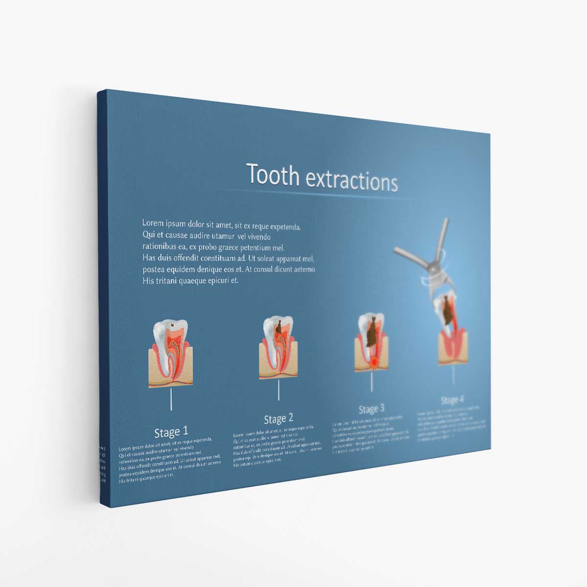 Tooth extraction concept . Four steps of decay tooth removal process f ...